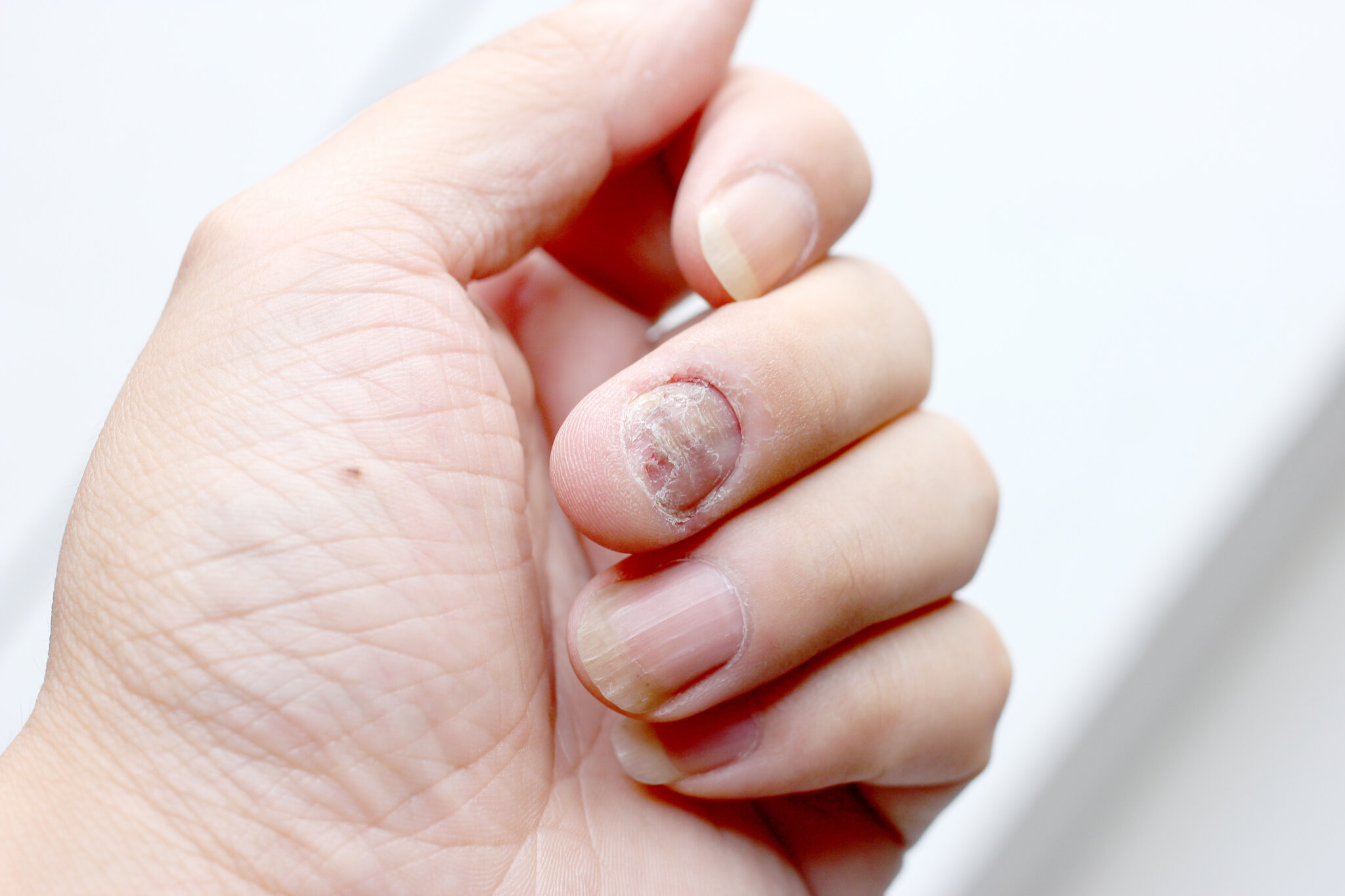 Psoriasis on the Hands and Feet – M-Folia